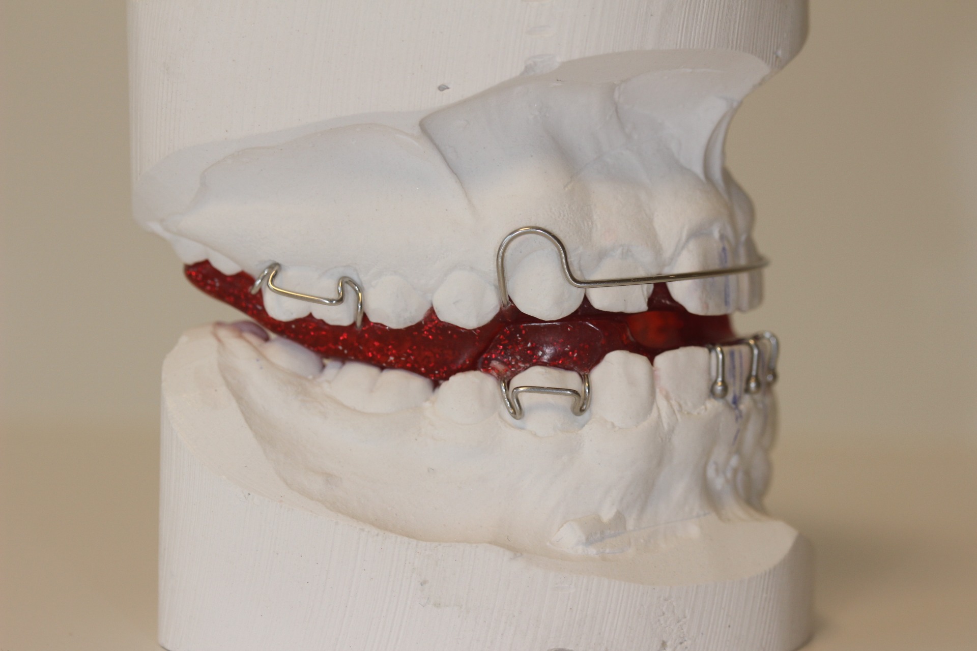 Uitneembare apparatuur :: Orthodontie Deboosere