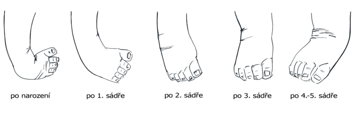 Sádrování a tenotomie :: Ponseti
