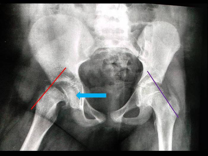 Epifisiolisis femoral proximal :: Imagenologosecuador