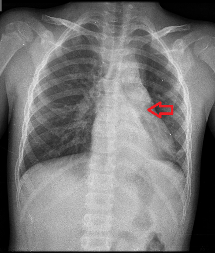 Atelectasia del lóbulo inferior izquierdo :: Imagenologosecuador