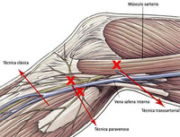 Neuralgia del nervio safeno :: Clinicaolmoangelvandeyzenvalencia