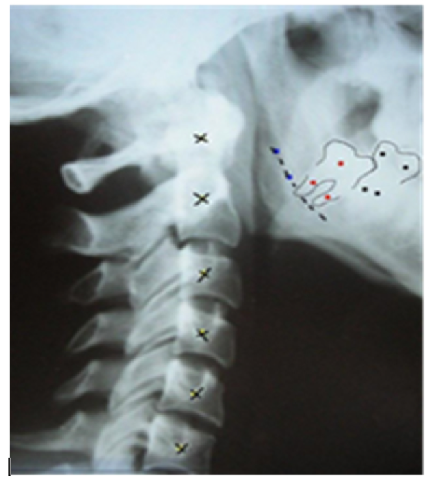 Cervicalgia. Rectificación cervical. :: Clinicaolmoangelvandeyzenvalencia