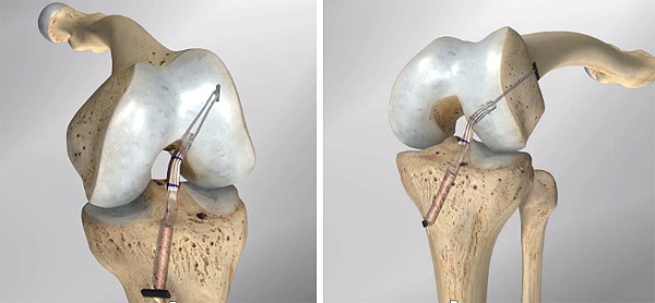Plastia de Ligamento Cruzado Anterior. ¿En qué consiste? :: artroscopia ...