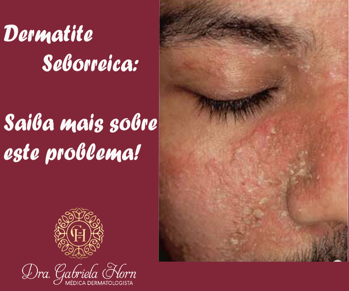 Dermatite Seborreica: Saiba mais sobre este problema :: Dra. Gabriela ...
