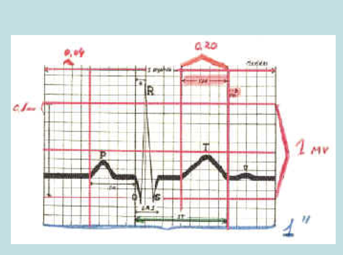 Lectura de ECG Normal