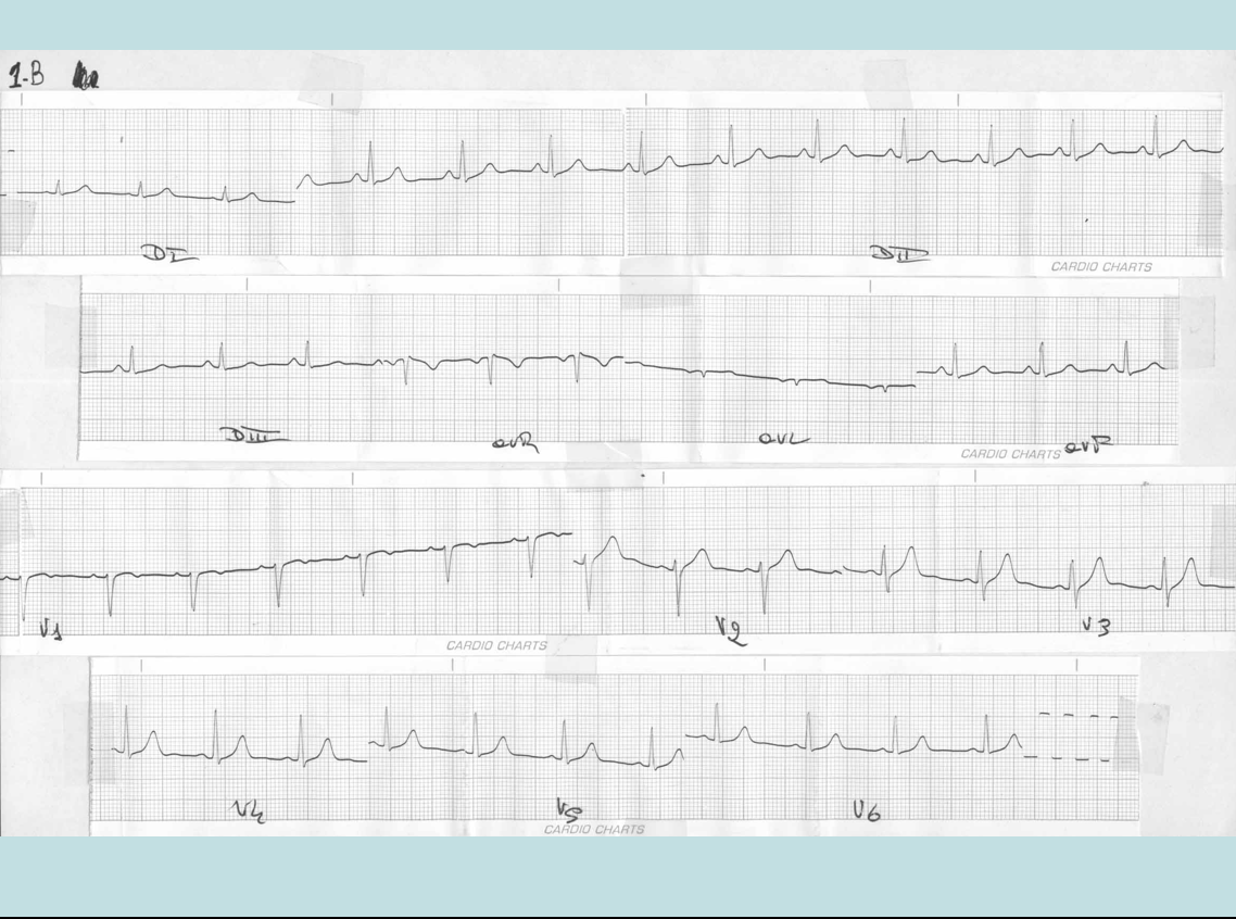 Lectura de ECG Normal