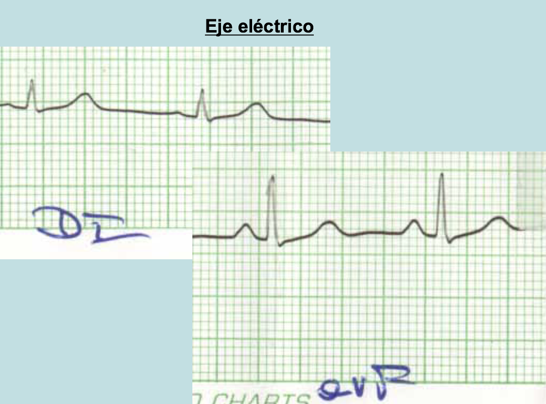 Lectura de ECG Normal
