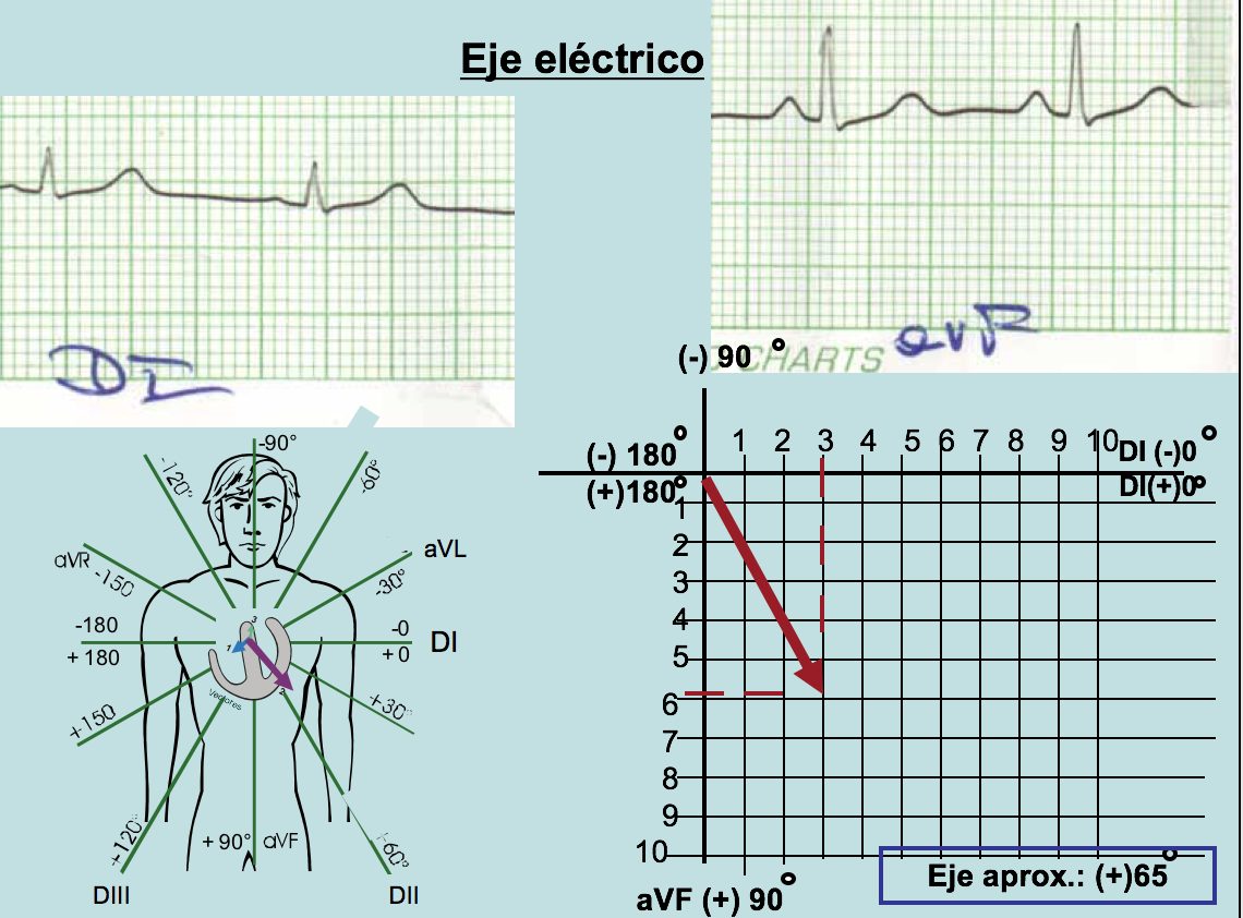 Lectura de ECG Normal